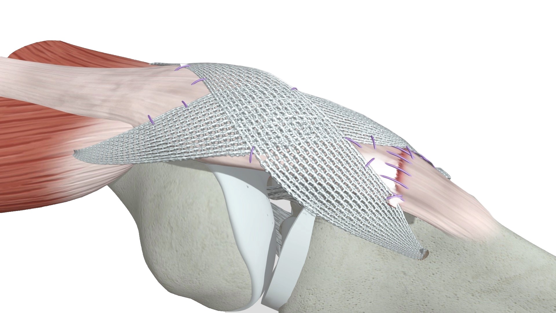 Poly-Tape for Patellar Tendon Reconstruction - Implant Service Uw ...